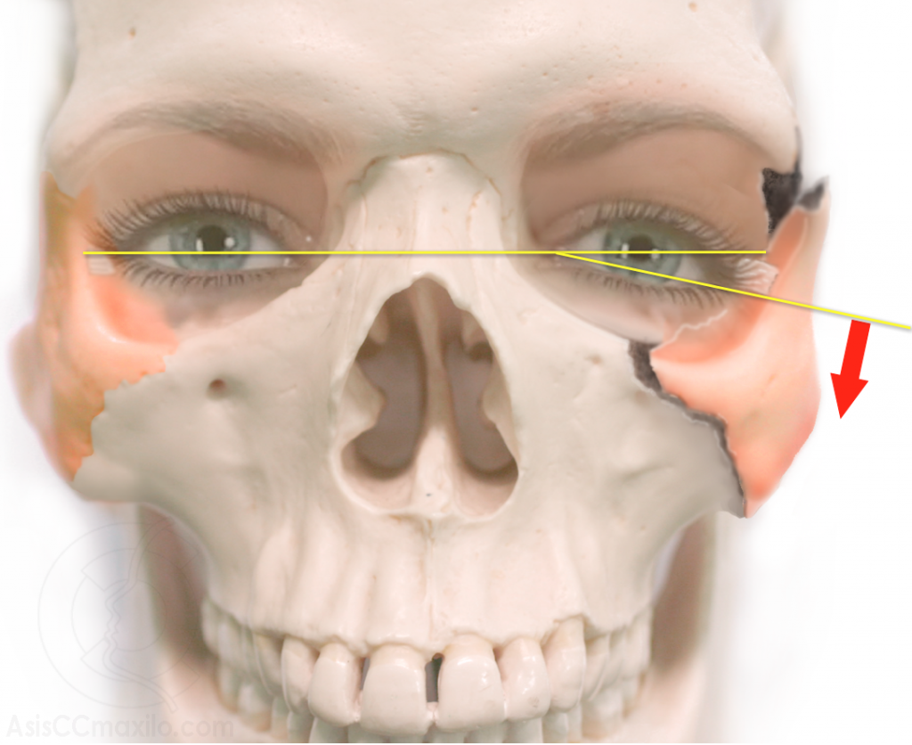 Dr. Javier Calderón Polanco » Fracturas de Malar