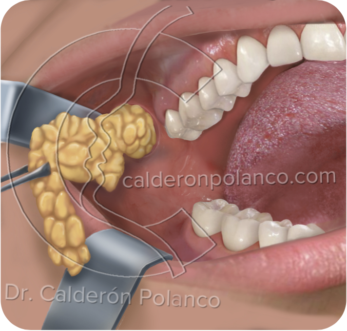 Dr. Javier Calderón Polanco » BIchectomía: extirpación de la Bola de Bichat