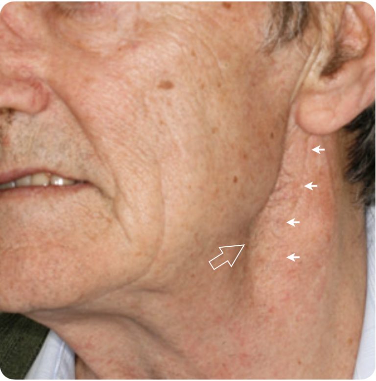 Dr. Javier Calderón Polanco » Cirugía de la Parótida