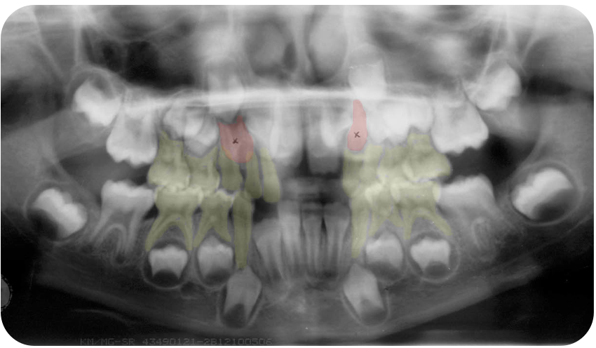 Dr. Javier Calderón Polanco » Dientes Supernumerarios