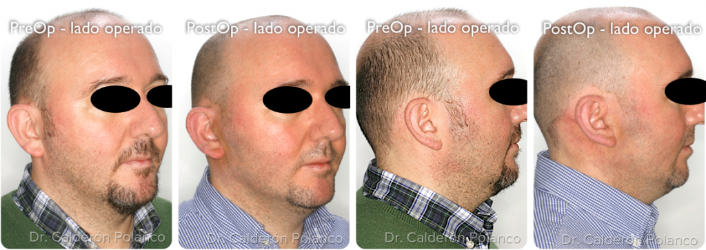 Dr. Javier Calderón Polanco » Cirugía de la Parótida