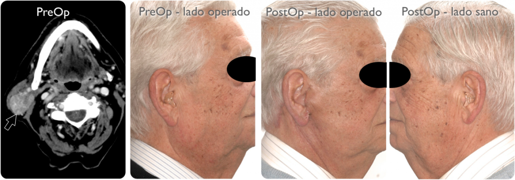 Dr. Javier Calderón Polanco » Cirugía de la Parótida