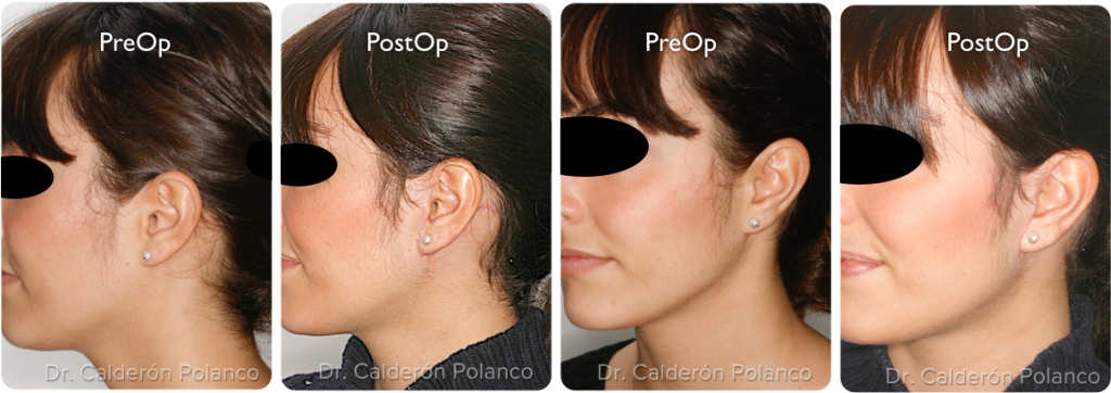 Dr. Javier Calderón Polanco » Cirugía de la Parótida