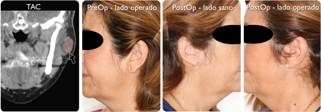 Dr. Javier Calderón Polanco » Cirugía de la Parótida