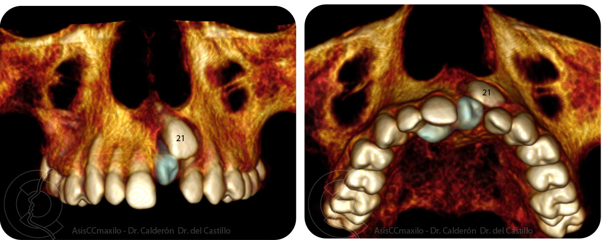 Dr. Javier Calderón Polanco » Dientes Supernumerarios