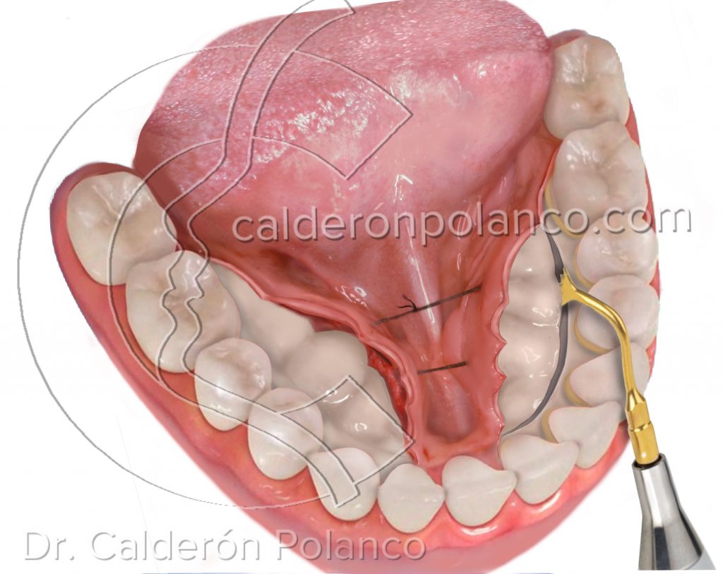 Dr. Javier Calderón Polanco » Torus y Exóstosis