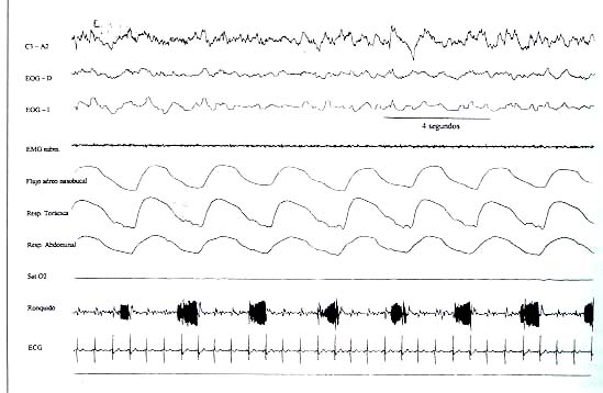 Dr. Javier Calderón Polanco » Apnea Obstructiva del Sueño