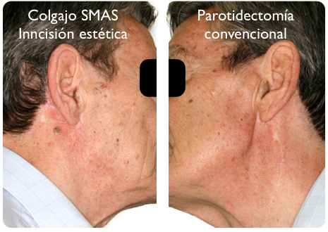 Dr. Javier Calderón Polanco » Cirugía de la Parótida