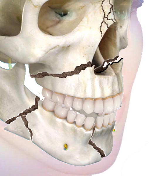 Dr Javier Calderón Polanco Fracturas Faciales