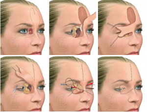 Dr. Javier Calderón Polanco » Reconstrucción Facial