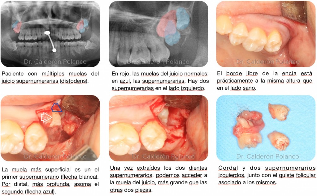 Dr. Javier Calderón Polanco » Dientes Supernumerarios