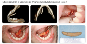 Dr. Javier Calderón Polanco » Cálculos Salivales